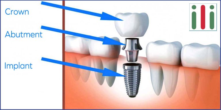 Two-phase Implants the Traditional implantation Method Part 2